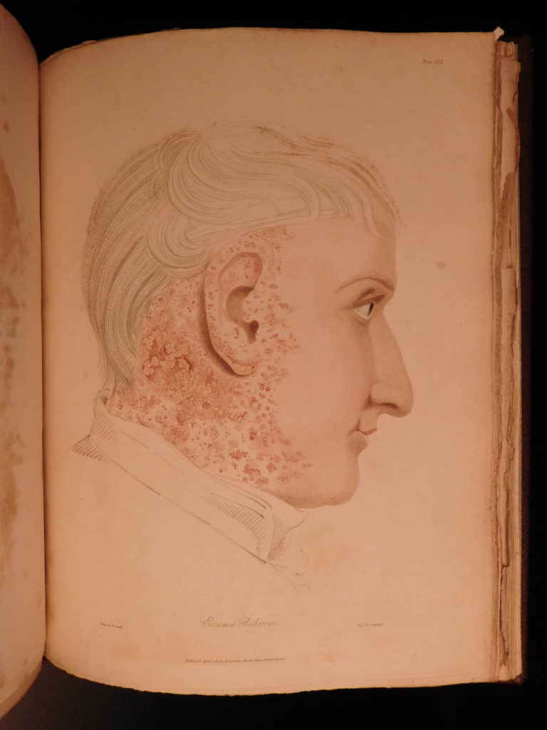 1817 1ed Delineations of SKIN Diseases Bateman Willian Dermatology ...